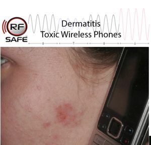 Dermatitis Cell Phone Radiation Study * RF SAFE® Radio Frequency Safe